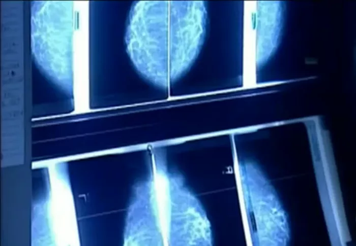 Orlando Offers Free 3D Mammograms for Low-Income Women in Need of ...